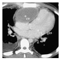 Pericardial cyst with right ventricular compression