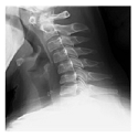 Calcification of the alar ligament of the cervical spine in a patient ...