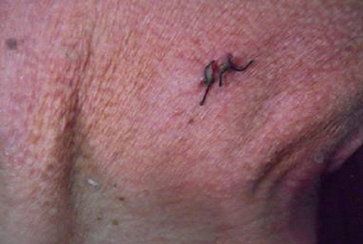 Figure Figure 1-Yellow papules: the iceberg of systemic elastorrhexis