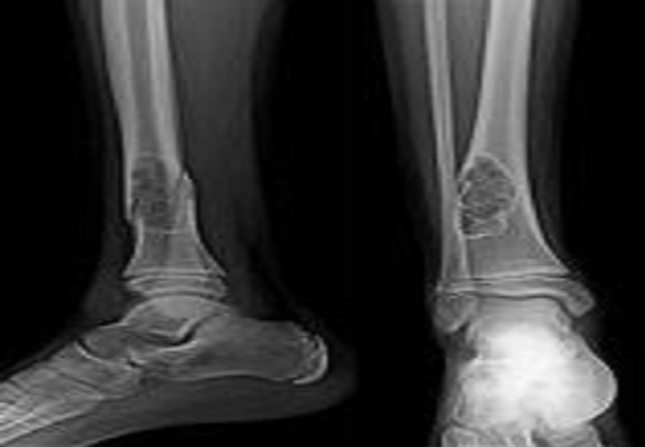 Figure 2: Aneurysmal bone cyst primary. About eight pediatric cases ...