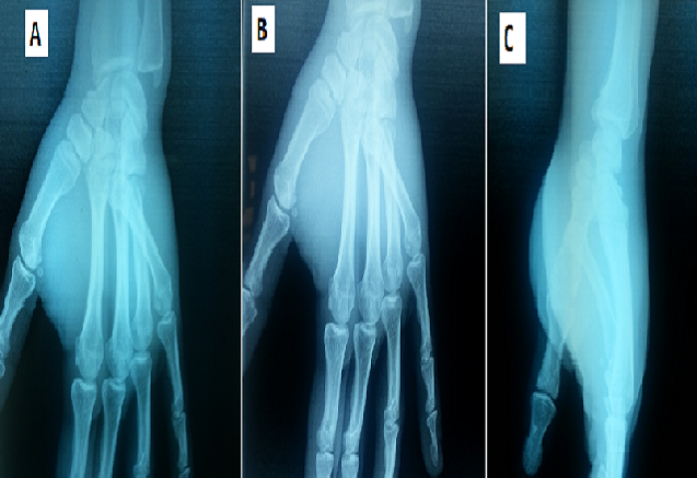 Figure Figure 1-Isolated radial volar dislocation of the fifth ...