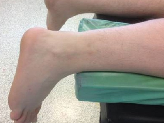 Figure Figure 1-La ténorraphie percutanée dans les ruptures fraîches du ...