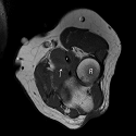 Preoperative diagnosis of bicipitoradial bursitis: a case report