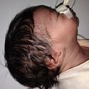 Bilateral maxillo-mandibular syngnathia in a newborn