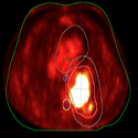 Volumetric modulated arc radiation therapy in the treatment of lung ...