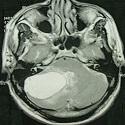 Simple intraparenchymal cyst of the cerebellum
