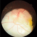 Severe congenital ocular coloboma