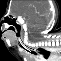 Severe Klippel-Feil syndrome with Mondini malformation of inner ear