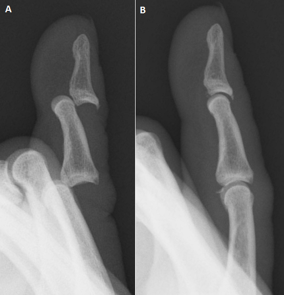 Figure Figure 2-Simultaneous double dislocation of the interphalangeal ...