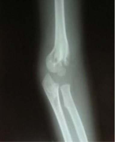 Figure 1: Technique de Blount dans le traitement des fractures supra ...