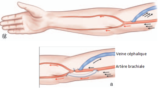 Figure 4: Prise en charge des complications des fistules artério ...