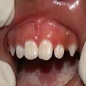 Oral and dental lesions in HIV infected Nigerian children