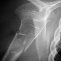 Les fractures pathologiques secondaires des tumeurs bénignes chez l ...