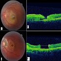 Macular hole following contusion syndrome