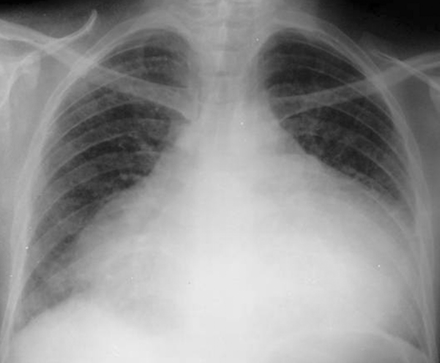 Figure Figure 1-La tamponnade cardiaque: une manifestation rare de l ...