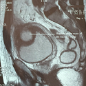 Cavernous hemangioma of the bladder: an additional case managed by ...
