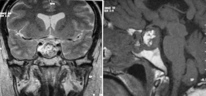 Figure Figure 4-Kyste arachnoidien intra et supra sellaire: apport de l’IRM