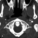 An unusual etiology of posttraumatic Collet–Sicard Syndrome: a case report