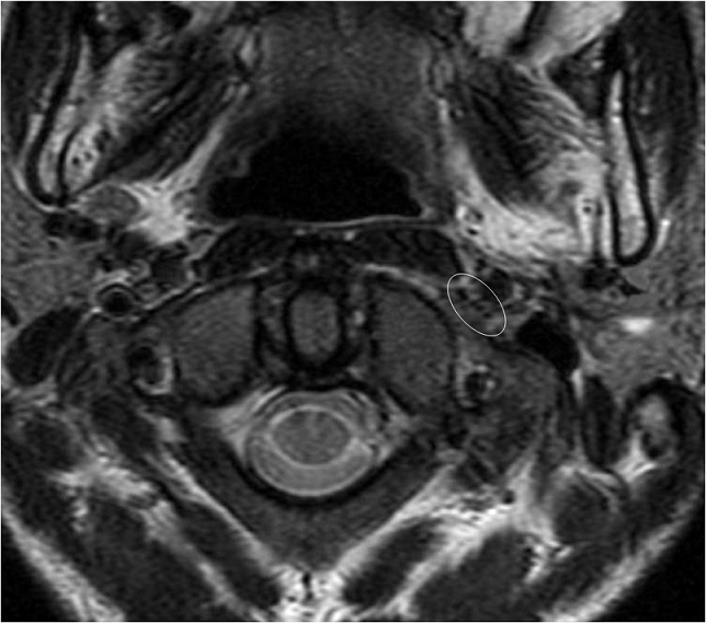 Figure 2: An unusual etiology of posttraumatic Collet–Sicard Syndrome ...