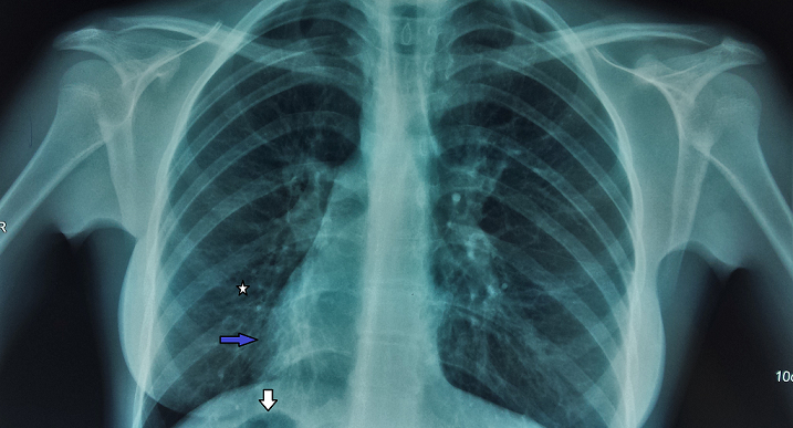 Figure Figure 1-A case of Kartagener syndrome with rhinolalia clausa