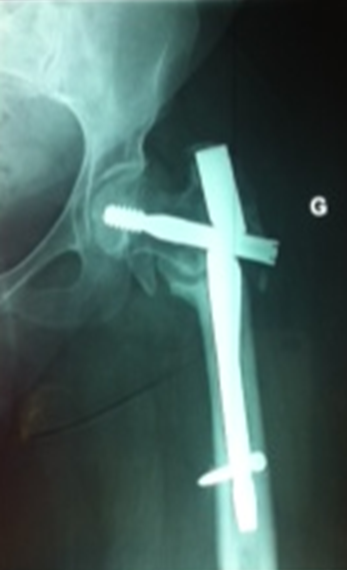 Figure Figure 1-Intertrochanteric fracture non-unions with implant ...