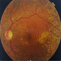 Fundus albipunctatus