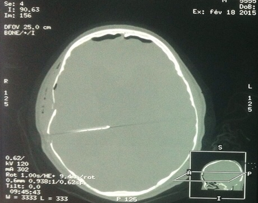Figure Figure 1-Embarrure suite à l’utilisation de la têtière de ...