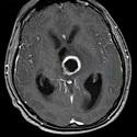 Thalamic abscess caused by a rare pathogen: streptococcus constellatus