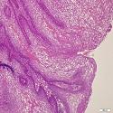 A rare cause of acute urinary retention in women: meatal condyloma ...