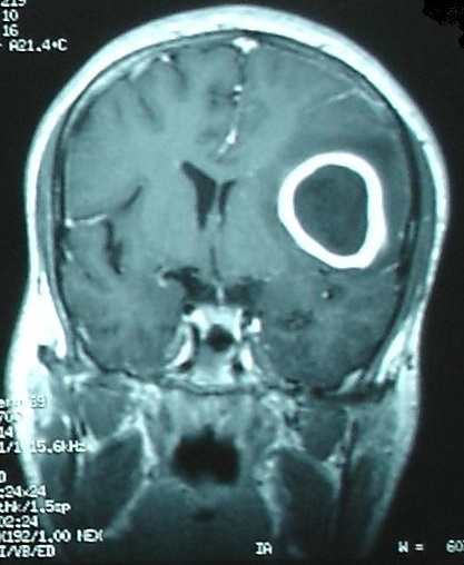 Hereditary Hemorrhagic Telangiectasia Brain