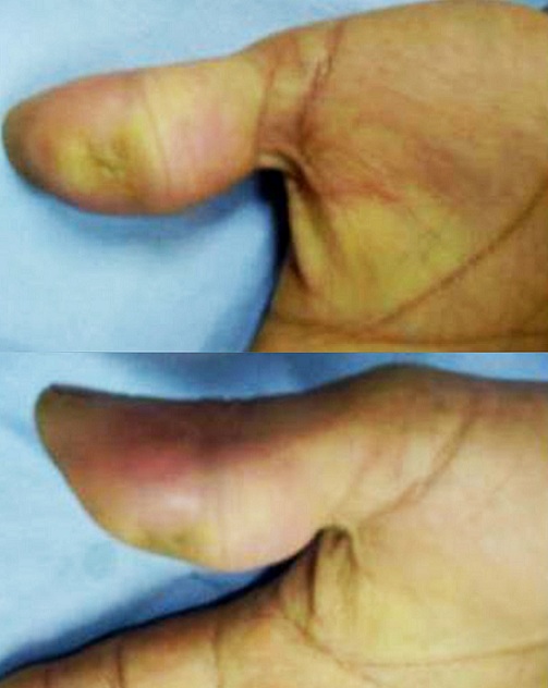 Figure Figure 7-Pseudotumoral form of soft tissue tuberculosis of the ...