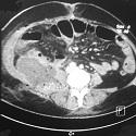 Taenia saginata: an unusual cause of post-appendectomy faecal fistula