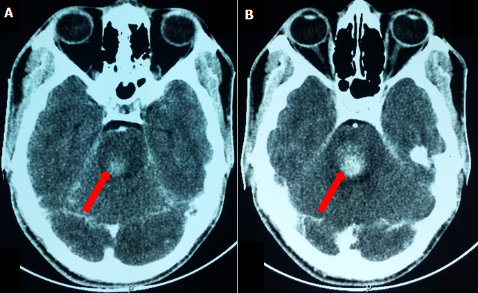 Figure Figure 1-Superior Foville syndrome due to pontine hemorrhage: a ...