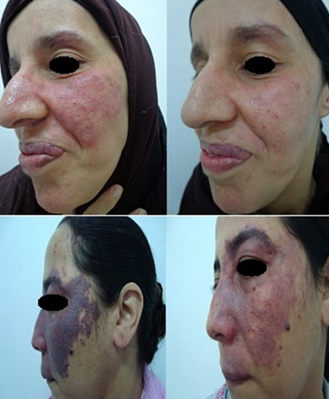 Figure Figure 1-Angiomes plans et laser à colorant pulsé: étude des ...