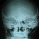 Skeletal fluorosis: a rare cause of diffuse bone condensation