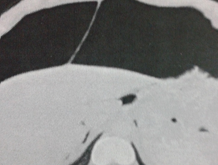 Figure Figure 1-Un cas rare de pneumopéritoine spontané massif: à ...