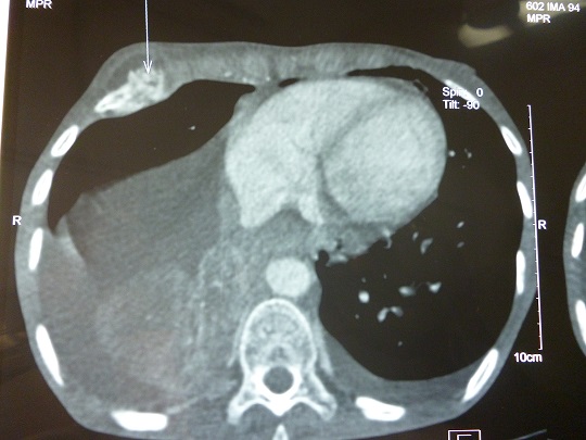Figure 2: Métastase costale révélant un carcinome épidermoïde de l’œsophage