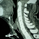Giant laryngeal polyp: an unusual indication of tracheostomy