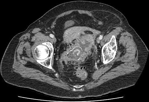Figure Figure 1-Iléus biliaire colique: une cause rare d’occlusion colique