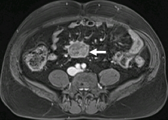 Figure Figure 3-Sclerosing mesenteritis: a benign cause of mesenteric ...