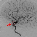 Injury of an aberrant internal carotid artery after myringotomy