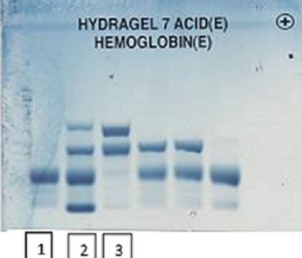 Figure Figure 3-Découverte fortuite d'une drépanocytose hétérozygote ...