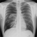 Hypoxemia after pneumothorax exsufflation: a case report