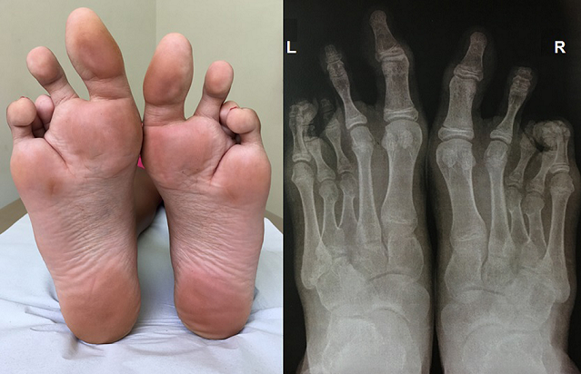 Cleft Foot