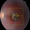 Colobome maculaire unilatérale: à propos d’un cas
