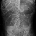 Diagnosis and surgical management of congenital intestinal malrotation ...