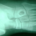 Osteitis of the cuboid on unknown foreign body