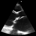 Giant left atrium causing severe dysphagia