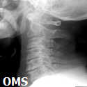 Application of the Canadian C-Spine rule and nexus low criteria and ...