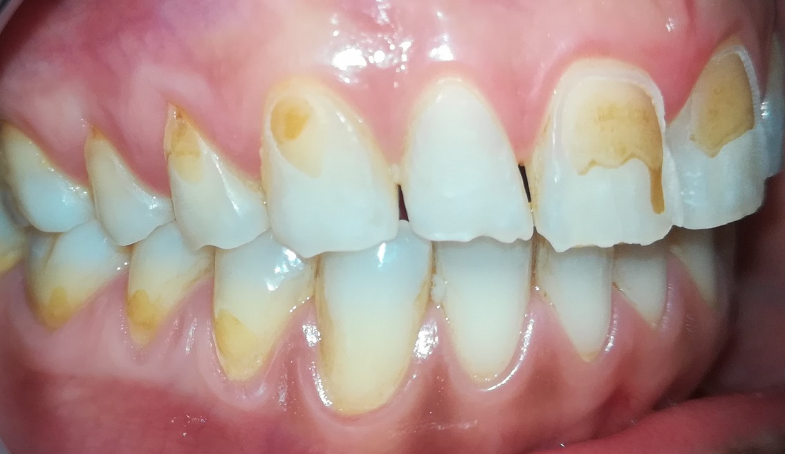 Lemon Erosion Enamel